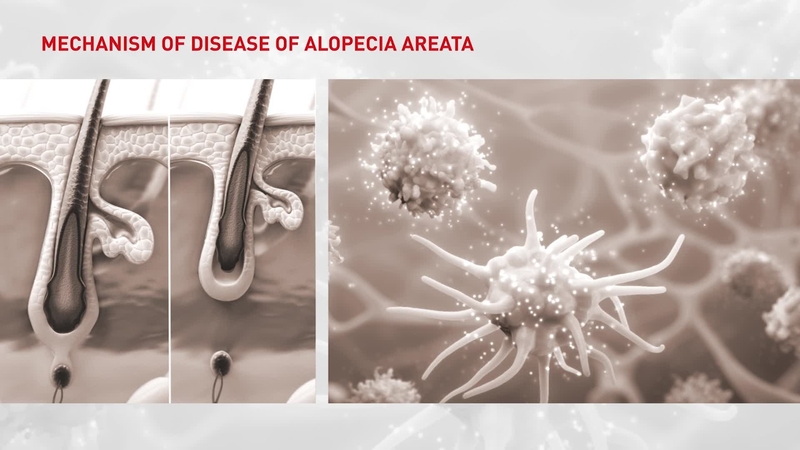 Alopecia Areata Disease Education Resources - Lilly Medical Education