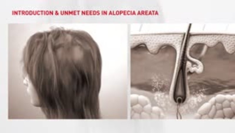 Alopecia Areata Disease Education Resources - Lilly Medical Education